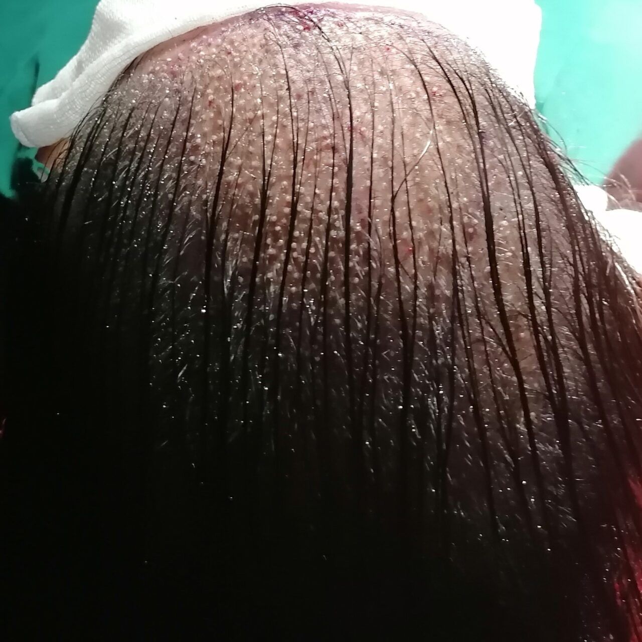 IMPLANT DE PAR LA FEMEI | Transylvania Hair Clinic
